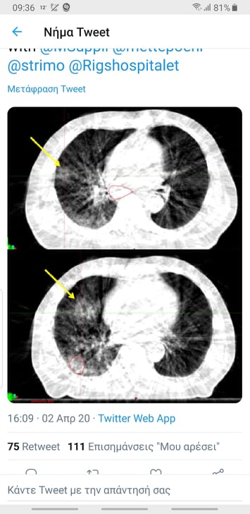 Oncocare - Γ. Κριτσέλης | Πρωιμη ανιχνευση του covid-19 σε ασθενεις με ...